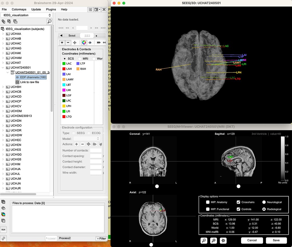 Display sensors -> cortex opens MRI viewer in addition to cortex view - Bugs - Brainstorm
