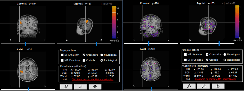 Dual Overlays in MRI Viewer - Discussions - Brainstorm