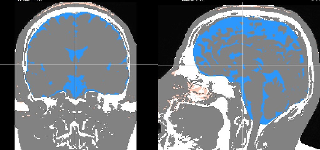 CAT12 tissue segmentation error - Bugs - Brainstorm