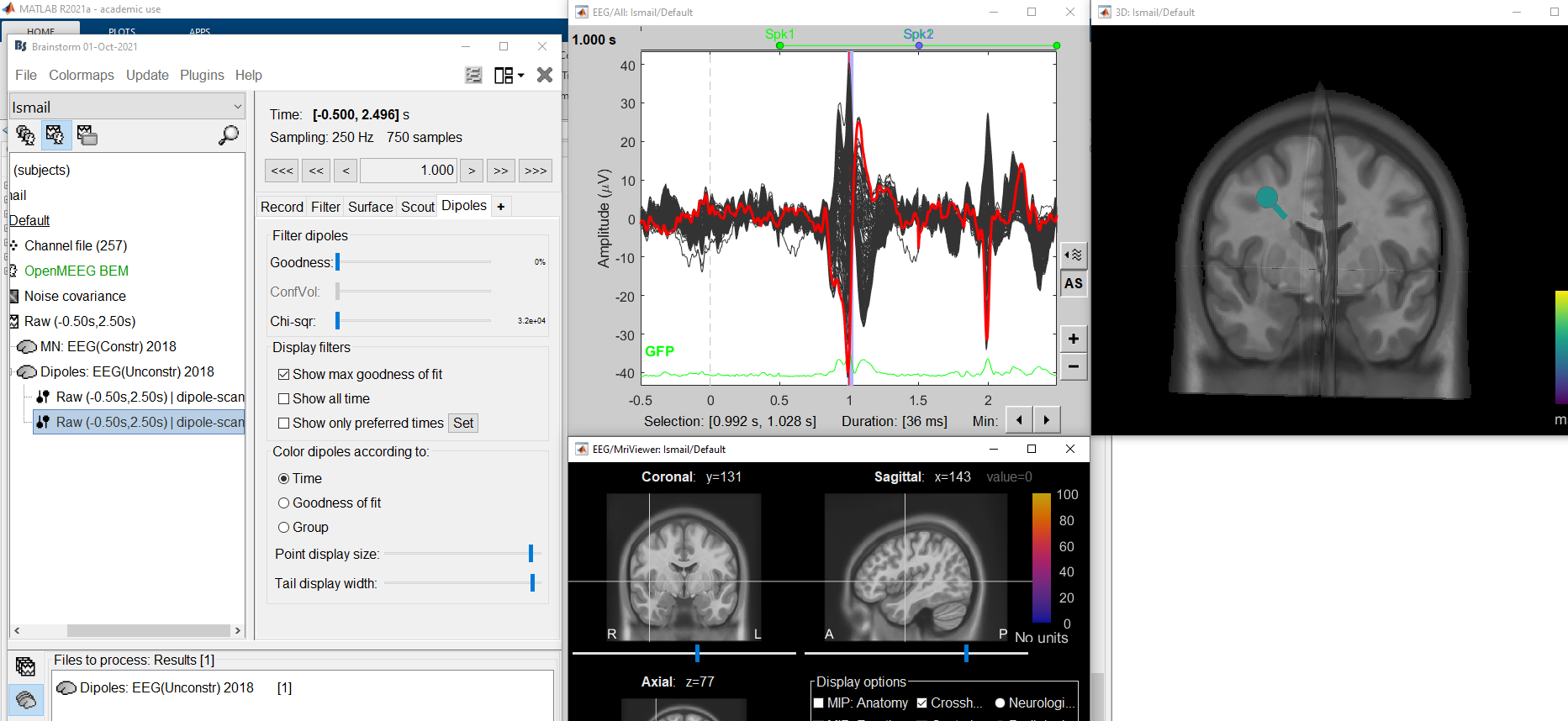 Localizing epileptic spike using diploe modeling - Brainstorm